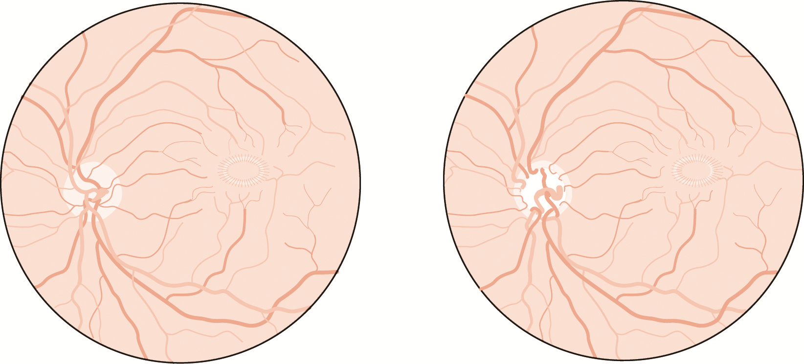 Glaucoom - Artikelen - Klinische Diagnostiek